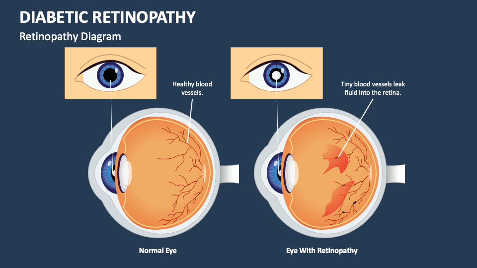 Diabetic Retinopathy PowerPoint and Google Slides Template - PPT Slides Diabetic Retinopathy PowerPoint and Google Slides Template - PPT Slides