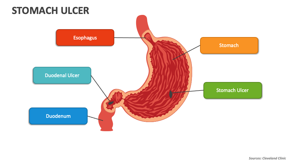 Stomach Ulcer PowerPoint and Google Slides Template - PPT Slides