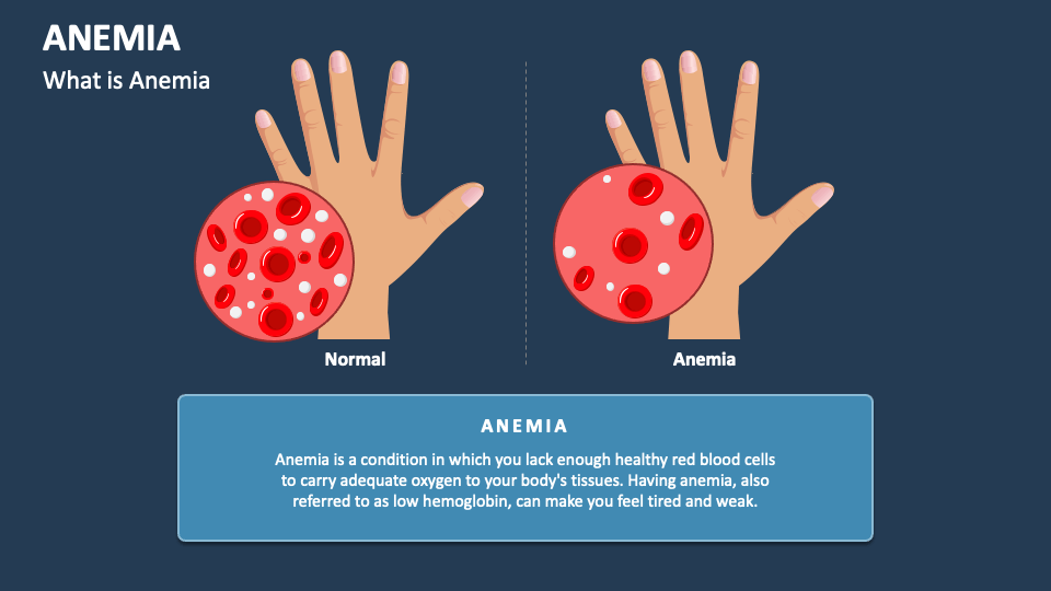 Anemia PowerPoint and Google Slides Template - PPT Slides