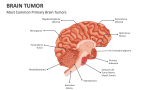 Brain Tumor PowerPoint and Google Slides Template - PPT Slides