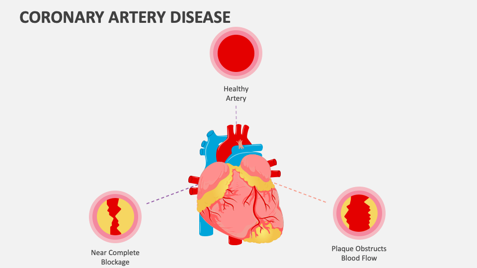 Coronary Artery Disease PowerPoint and Google Slides Template - PPT Slides