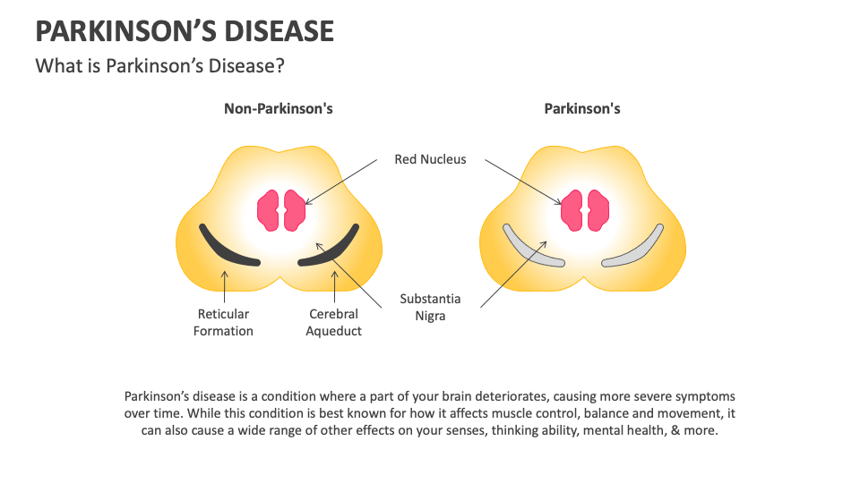 Parkinson's Disease PowerPoint and Google Slides Template - PPT Slides