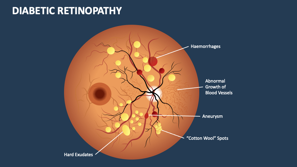 Diabetic Retinopathy PowerPoint and Google Slides Template - PPT Slides Diabetic Retinopathy PowerPoint and Google Slides Template - PPT Slides