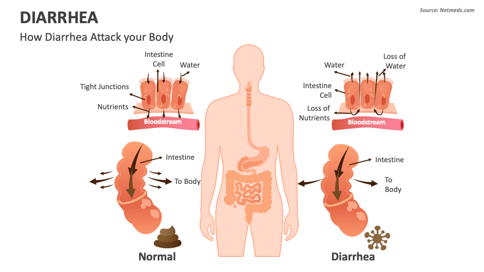 Diarrhea PowerPoint and Google Slides Template - PPT Slides