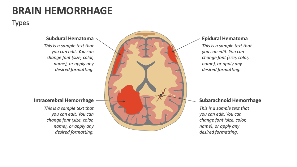 Brain Hemorrhage PowerPoint and Google Slides Template - PPT Slides