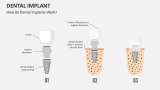 Dental Implant PowerPoint and Google Slides Template - PPT Slides