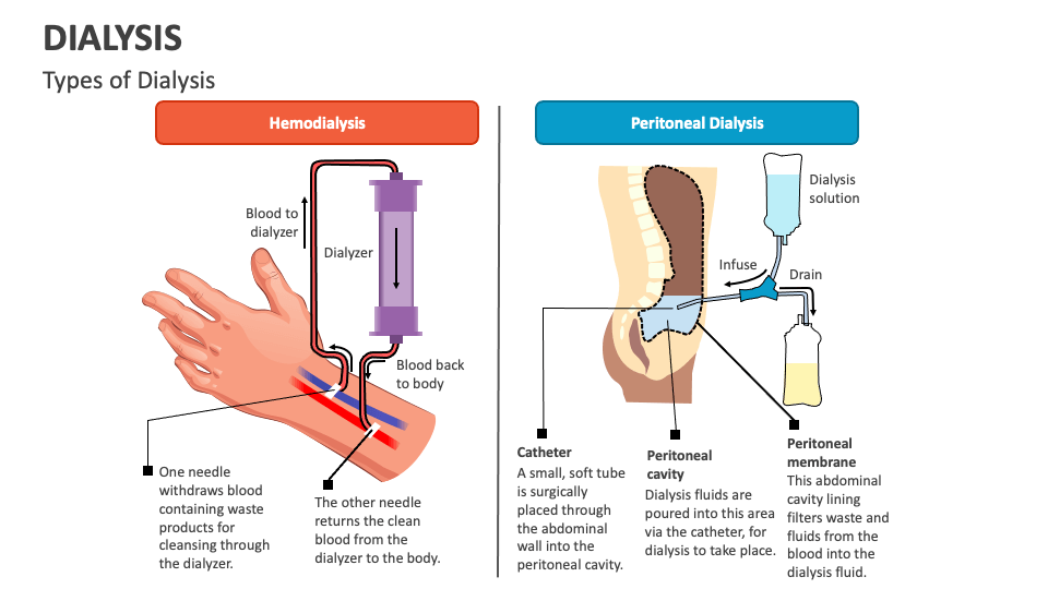Dialysis PowerPoint and Google Slides Template - PPT Slides