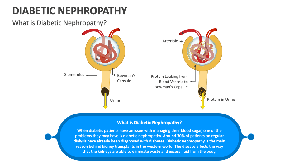 Diabetic Nephropathy PowerPoint and Google Slides Template - PPT Slides