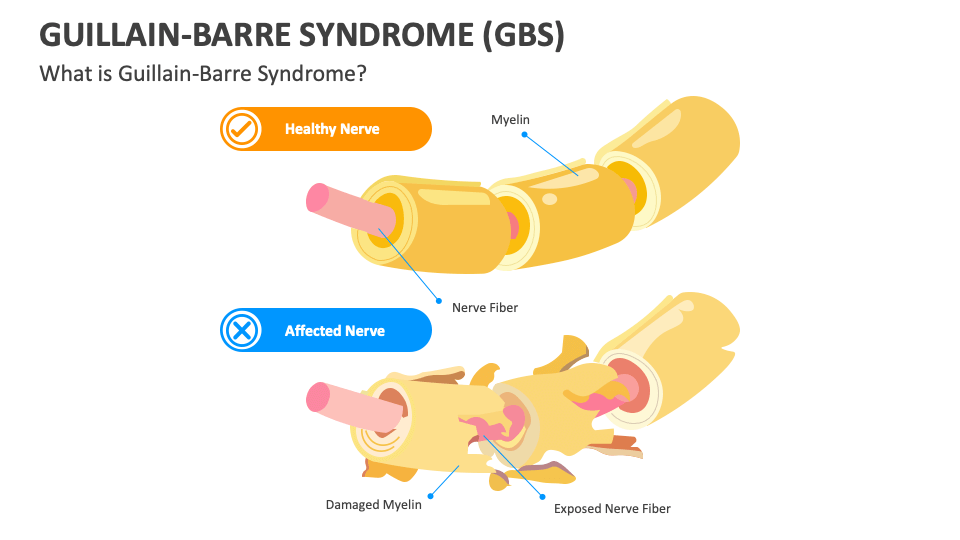 Guillain Barre Syndrome (GBS) PowerPoint and Google Slides Template - PPT Slides