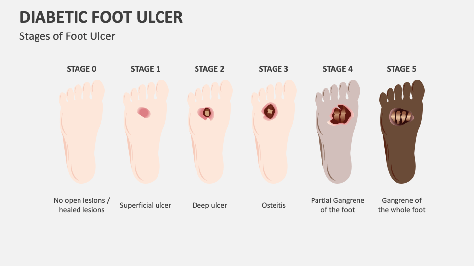 Diabetic Foot Ulcer PowerPoint and Google Slides Template - PPT Slides