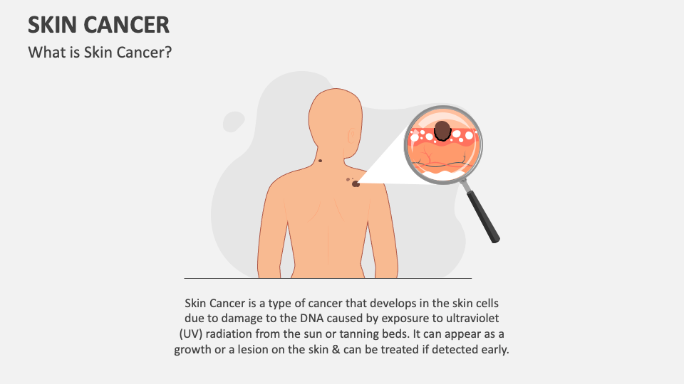 Skin Cancer PowerPoint and Google Slides Template - PPT Slides