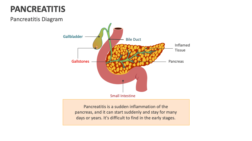 Pancreatitis PowerPoint and Google Slides Template - PPT Slides