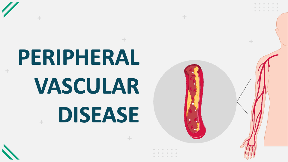 Peripheral Vascular Disease (PVD) Template for Google Slides and ...
