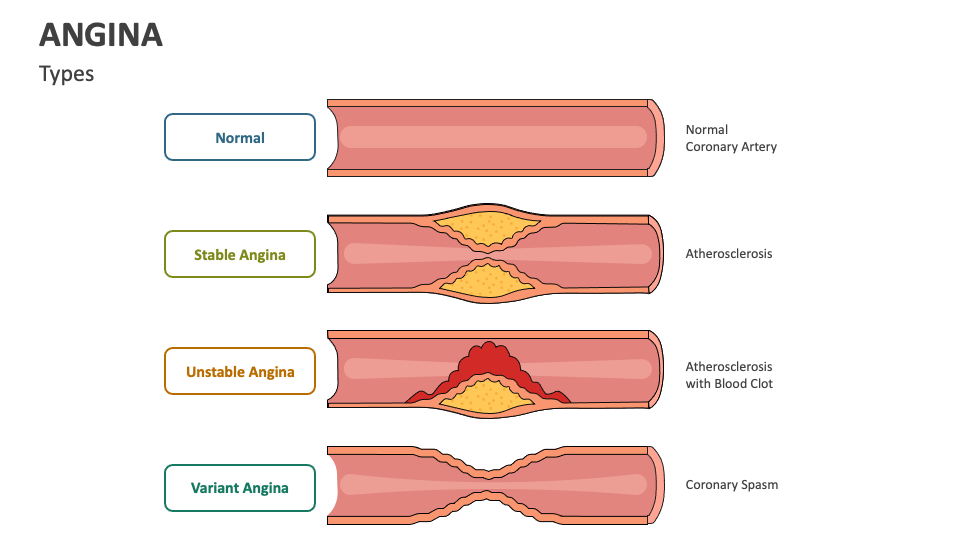 Angina PowerPoint and Google Slides Template - PPT Slides